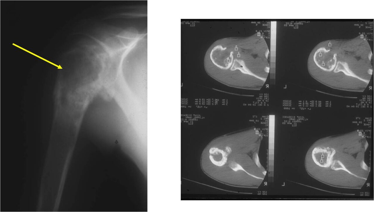 Ewing Sarcoma - Tumor Surgery Network